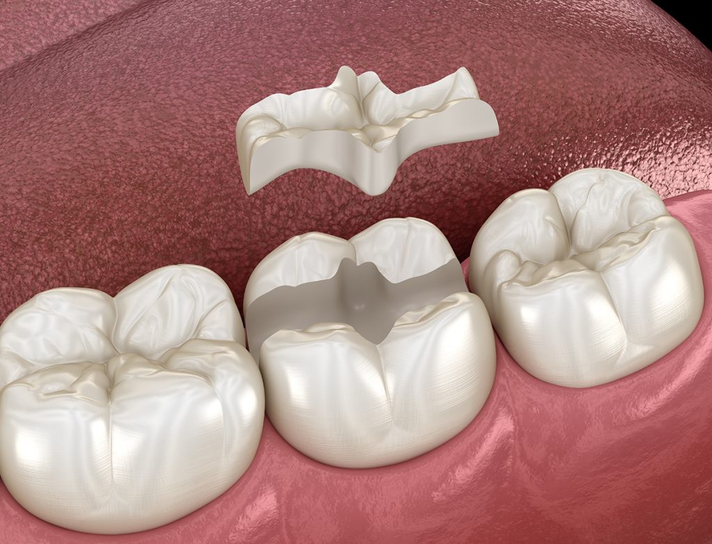 Porcelain Inlay - Baylee Dental